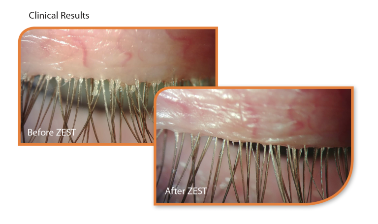 ZEST- Zocular Eyelid System Treatment - SpecsDirect2U Opticians